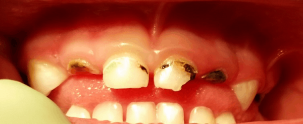 Before and After Photos - Katahdin Pediatric Dentistry