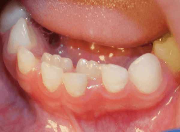 Common Problems - Katahdin Pediatric Dentistry